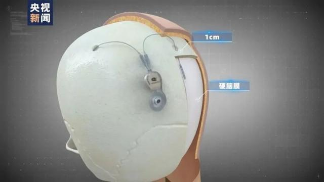 China: Brain-Computer Interface Assists Paralyzed Patients Regain ...